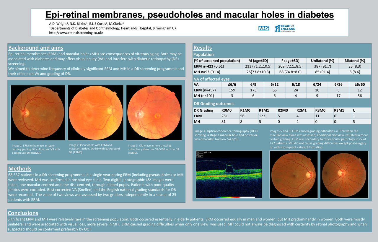 Epiretinal Membrane Pseudohole