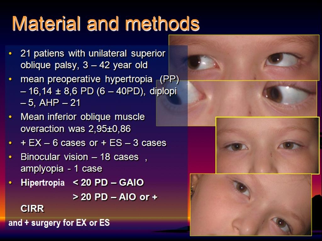 Inferior Oblique Palsy