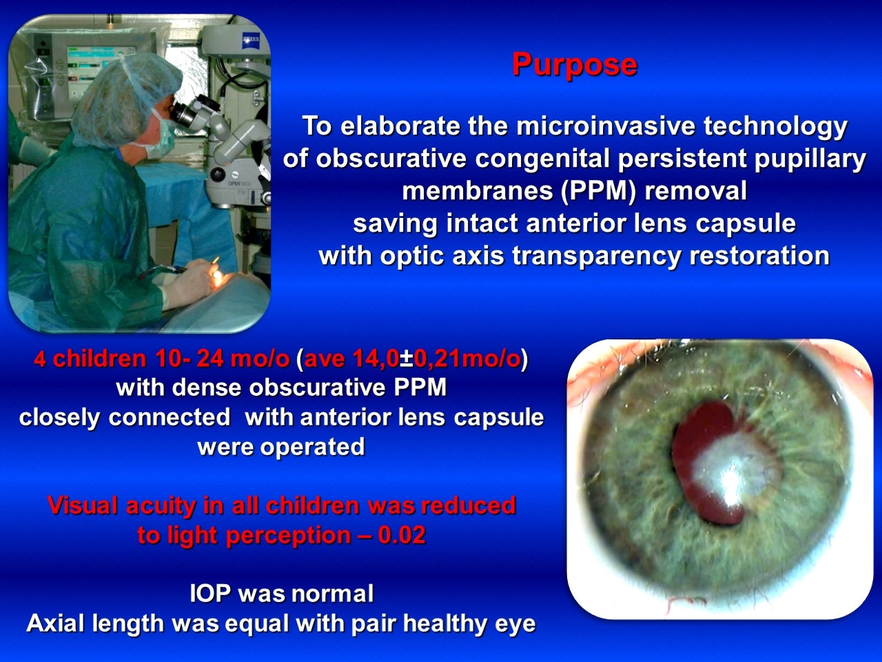 Partial Persistent Pupillary Membrane